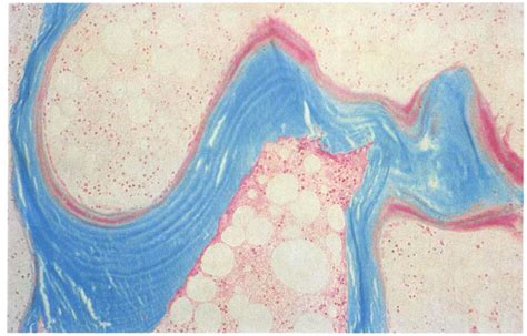 Goldner Stained Sample From Patient With Femoral Neck Fracture 11ox Download Scientific