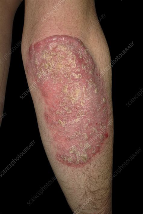 Pustular Psoriasis Stock Image C057 5197 Science Photo Library