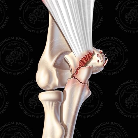 A Distracted Intra Articular Fracture Of The Left Olecranon Which Required An Open Reduction And