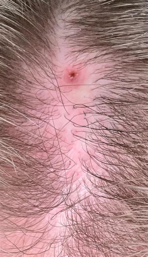 Scalp Biopsy Results Rfemalehairloss