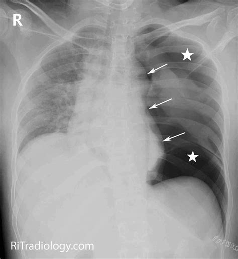 Rit Radiology Tension Pneumothorax