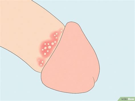 How To Get Rid Of Pimples On Your Pubic Area For Males