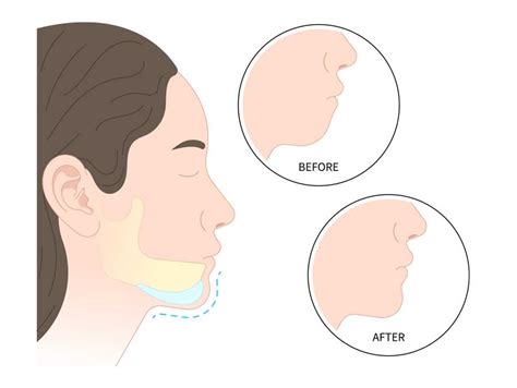 Understanding The Benefits Of Jawbone Augmentation Minnesota Oral And Facial Surgery