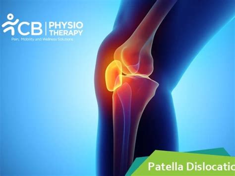 Top 5 Exercises For Patella Dislocationpng Top 5 Exercises For Patella Dislocationpng