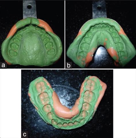 Pvs Impression At James Auxier Blog