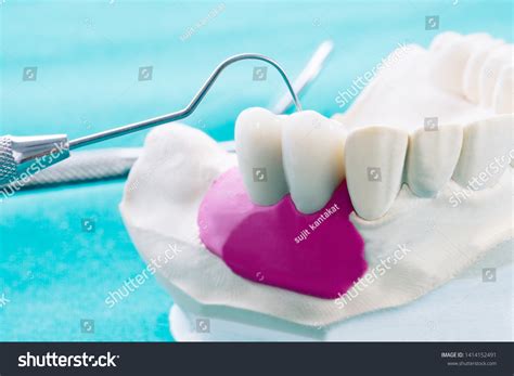 Implan Tooth Over 82 Royalty Free Licensable Stock Photos Shutterstock