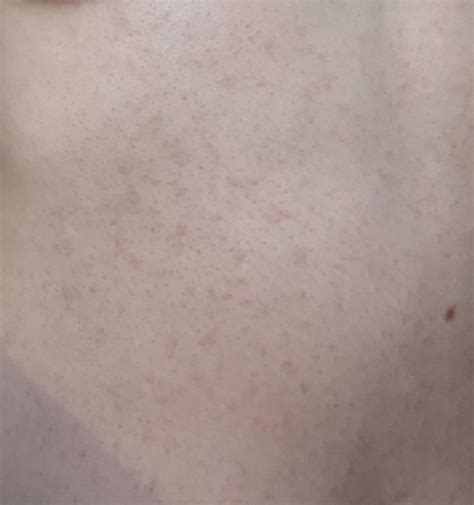 Can Fibromyalgia Be The Cause Of Rashes Rfibromyalgia