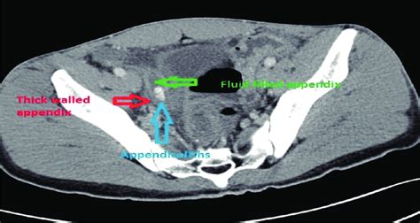 Showing Inflamed Appendix Arrows Single Headed Pointing To Abscess Download Scientific
