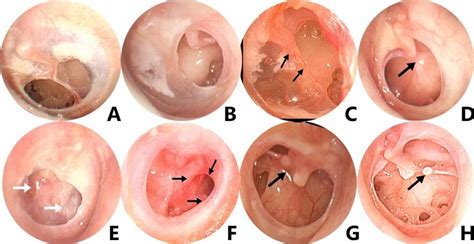 Infected Tympanic Membrane Tympanic Membrane Perforation Hole In