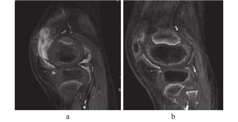 幼年特发性关节炎mri滑膜体积定量分析与血清学对比研究