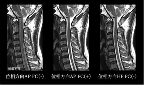 ★脊椎・脊髄検査でみられるアーチファクト