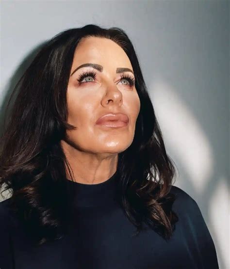 Botox Gone Wrong Forehead Botox Gone Wrong Forehead