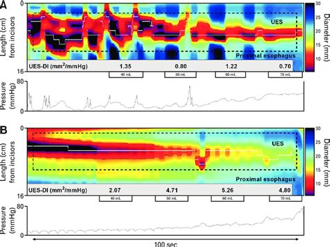 Example Of Upper Esophageal Sphincter Distensibility Index Ues Di Download Scientific Diagram