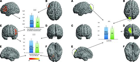 Comparison Of Gray Matter Volume Gmv Between The Patients With Right