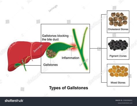 There Three Main Types Gallstones Gallstones Stock Vector Royalty Free