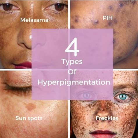 There Are 4 Main Types Of Hyperpigmentation Pih Post Inflammatory There Are 4 Main Types Of Hyperpigmentation Pih Post Inflammatory