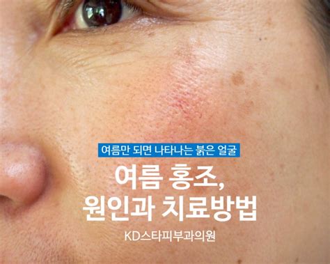 강동구피부과 가벼운 여름 안면홍조 원인과 치료방법은 네이버 블로그