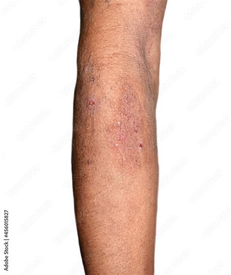 Niacin Deficiency Skin