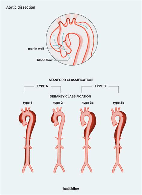 Aortic Dissection Medizzy