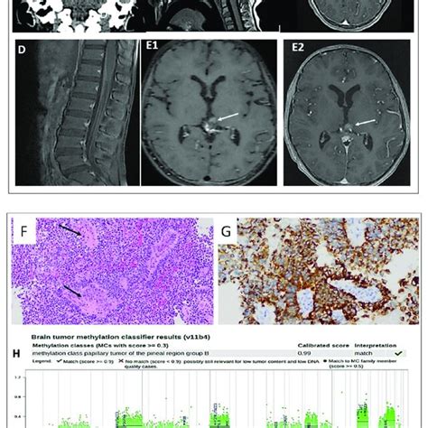 A Ct Scan Shows A Hyperdense Lesion With A Focus Of Central Download Scientific Diagram