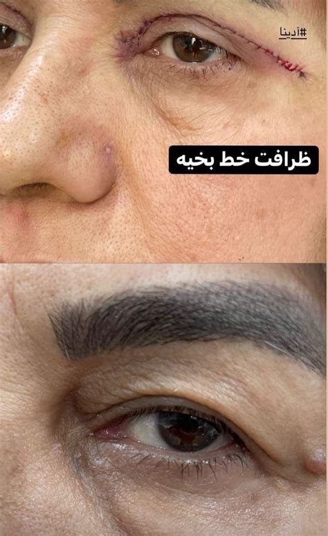 بیماری افتادگی پلک و راه درمان آن در تهران کوئیک فیت