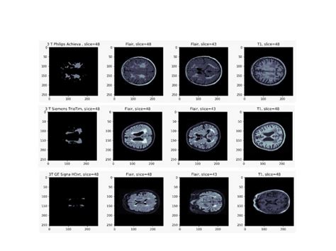 Deep Learning And Preprocessing For Brain Lesions Segmentation