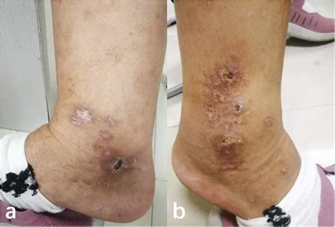 Refractory Segmental Hyaline Vasculitis Treated With Tofacitinib A Ca