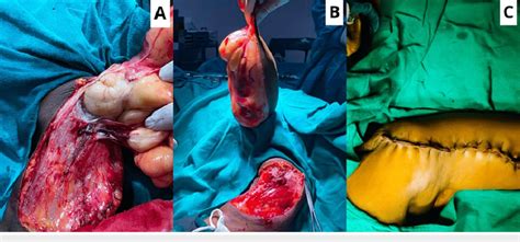 A An Intraoperative Picture Showing The Surgical Excision Of The