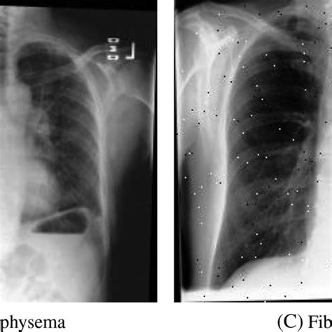 Original Sample Images In The NIH Chest Xray Dataset And ILD Database Download Scientific