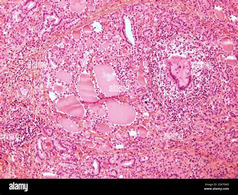 Subacute Granulomatous Thyroiditis Light Micrograph Of A Section