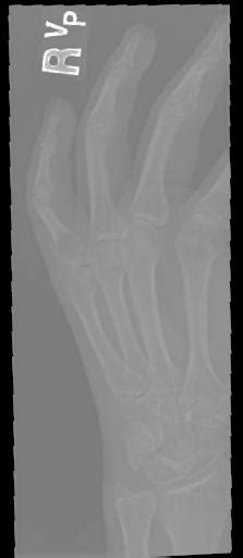 bone fracture detection object detection dataset v4 v4 by veda