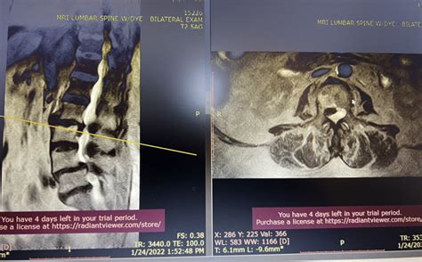 Today Case An Old Lady With Severe Rt Sided Sciatica No Significant