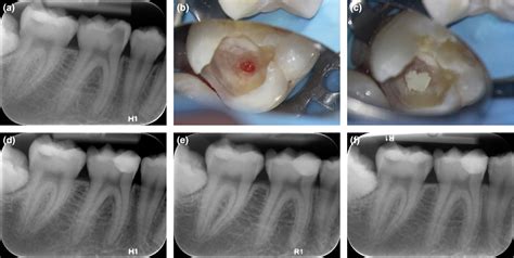 What Do Caries Look Like On X Ray At Lola Wall Blog