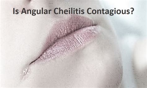Angular Cheilitis Contagious Angular Cheilitis Facts