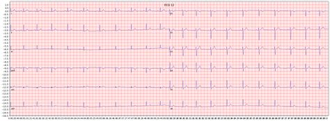 Examples Of Normal Ecg Norm Ecg Library