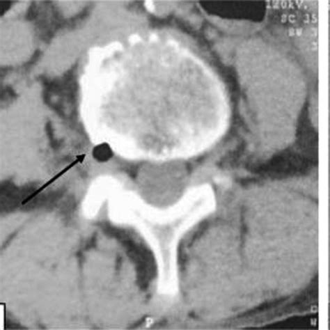 Spinal Ct Scan Axial Showing Foraminal Disk Protrusion With Intradiscal