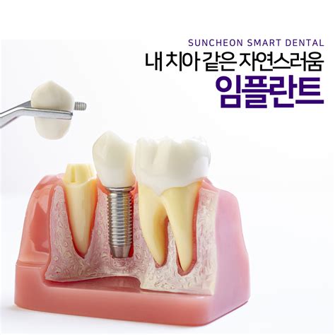 순천스마트치과 내 치아같은 자연스러움 임플란트 임플란트는 치아를 상실했을 경우 치아를 대신해주는
