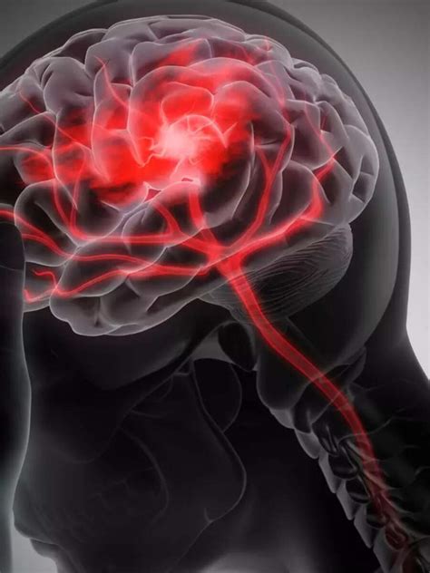 மூளை பக்கவாதம் ஏற்படாமல் தடுக்க உதவும் சில வழிகாட்டுதல்கள் Tamilsamayam