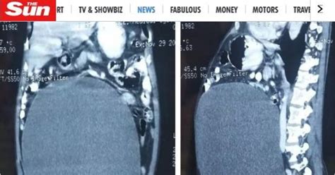 [뉴스pick] 6배 부풀어 오른 방광 소변 11l 빼낸 남성