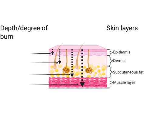 Classification Of Burns Quiz