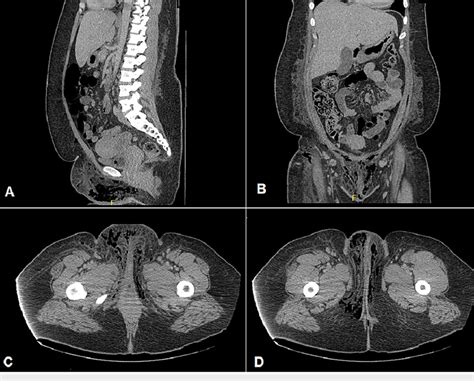 Ct Of Abdomen And Pelvis With Contrast Demonstrating Subcutaneous Download Scientific Diagram