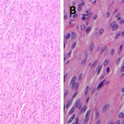 Gastrointestinal Stromal Tumor A Spindle Gastrointestinal Stromal Download Scientific Diagram