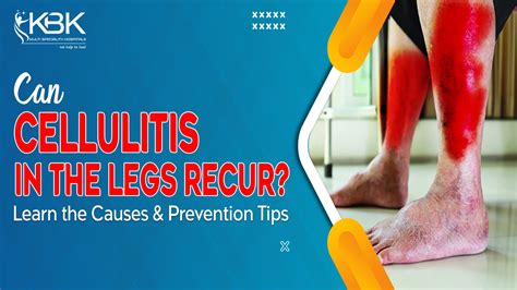 Cellulitis When To Worry Signs And Risks
