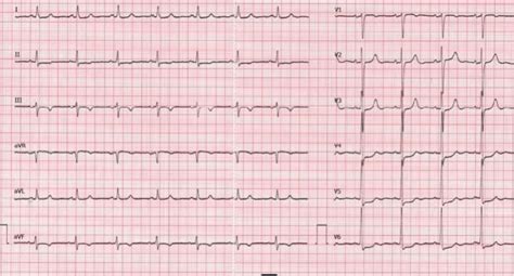Ecg Aspect Sinus Rhythm St Segment Depression In V4 V6 T Wave Download Scientific Diagram