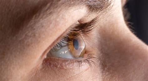 Keratoconus Corneal Transplant