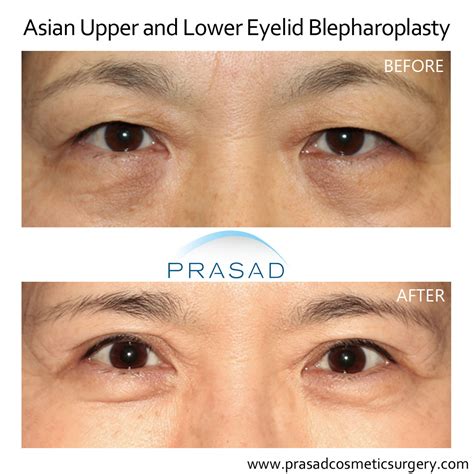 Double Eyelid Surgery Before And After Photos Dr Amiya Prasad