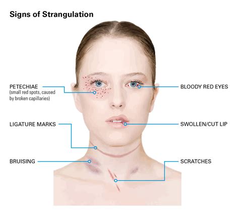 Petechiae Eye Strangulation