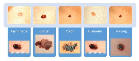 Traditional Clinical Analysis Followed By Dermatologists Abcde Rule