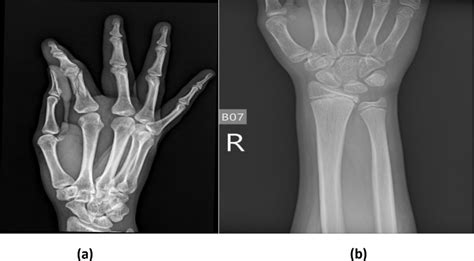 Frontiers Diagnosis And Detection Of Bone Fracture In Radiographic