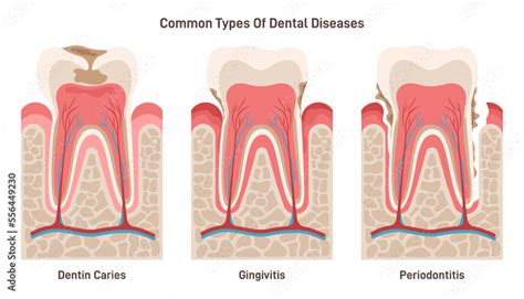 Dental Disease Set Dentin Caries Gingivitis And Periodontitis Oral